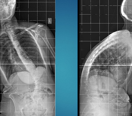 Kyphoscoliosis in a patient with Parkinsons Disease - Spine Surgery Greece