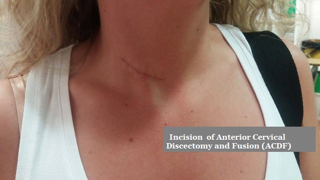 Cervical Disc Herniation - Spine Conditions - Spine Surgery Greece